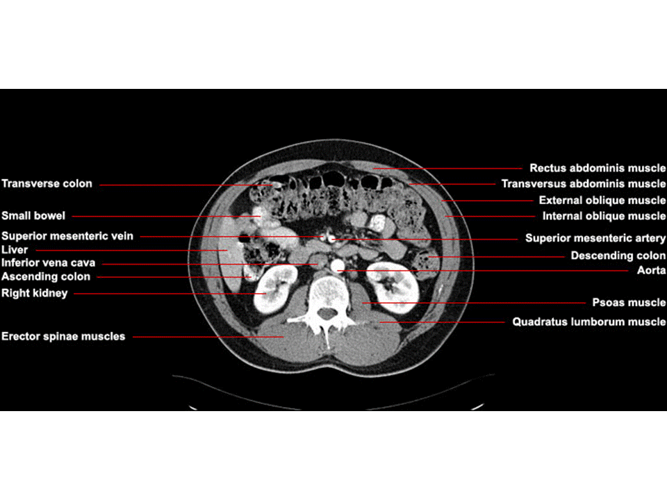 CT of the Abdomen Axial Anatomy – RADIOLOGYPICS.COM