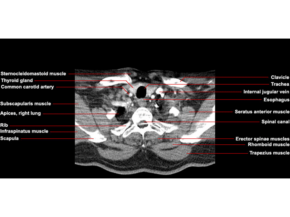 CT Neck Axial Anatomy – RADIOLOGYPICS.COM
