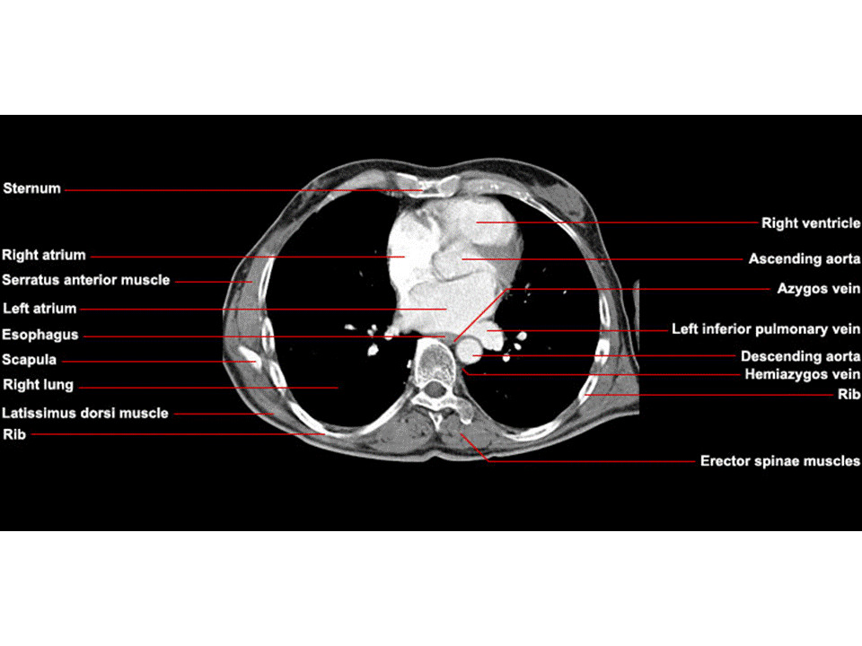 CT of the Chest Soft Tissue Windows Axial Anatomy – RADIOLOGYPICS.COM