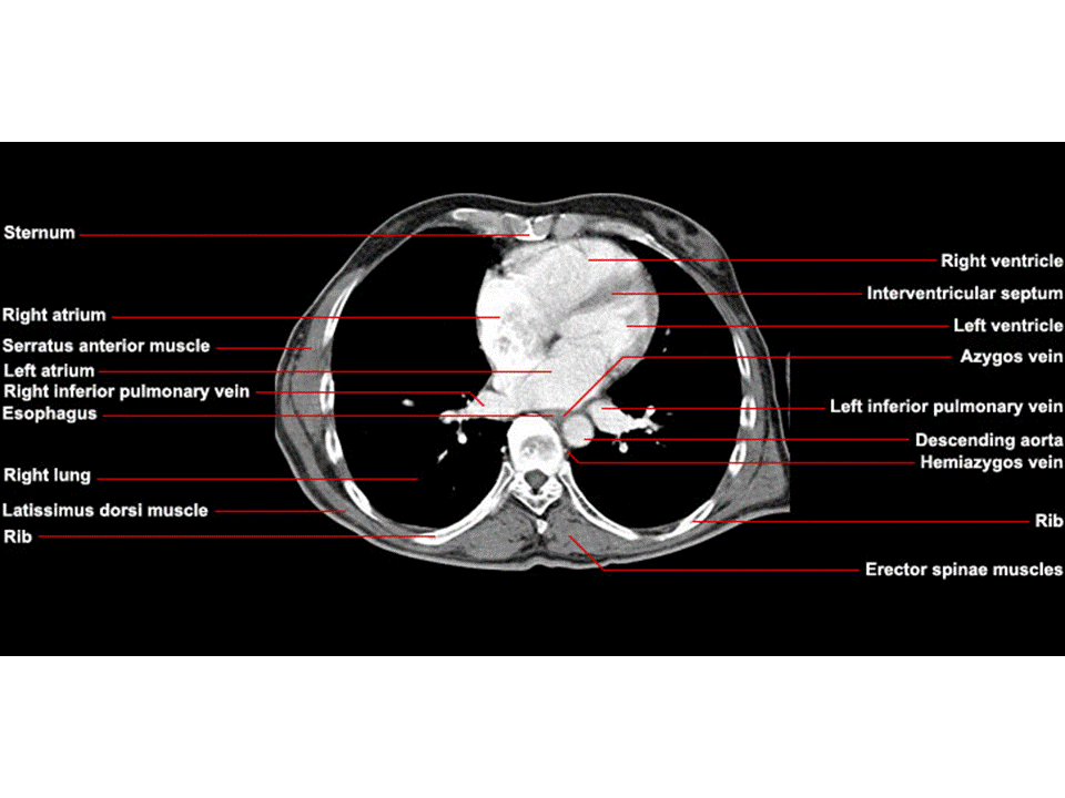 CT of the Chest Soft Tissue Windows Axial Anatomy – RADIOLOGYPICS.COM