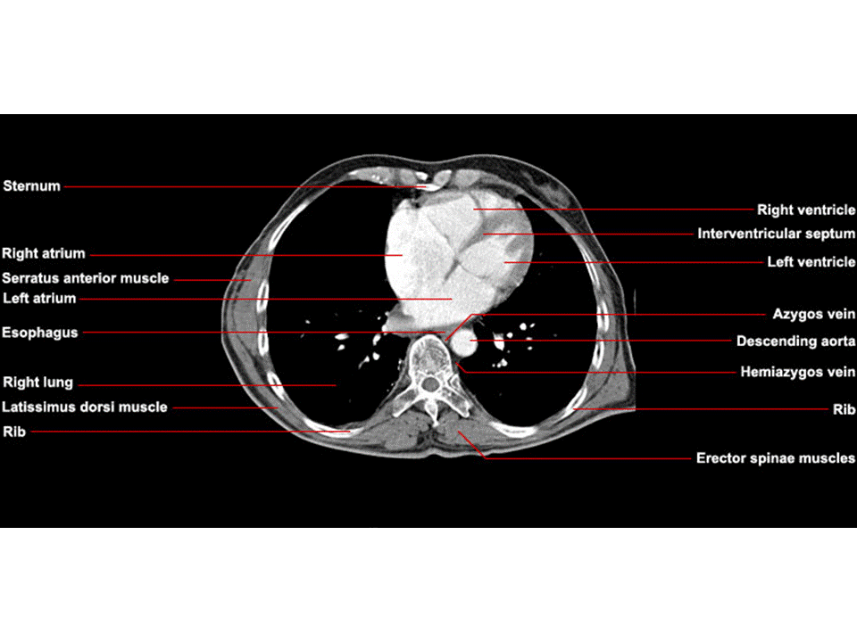 CT of the Chest Soft Tissue Windows Axial Anatomy – RADIOLOGYPICS.COM