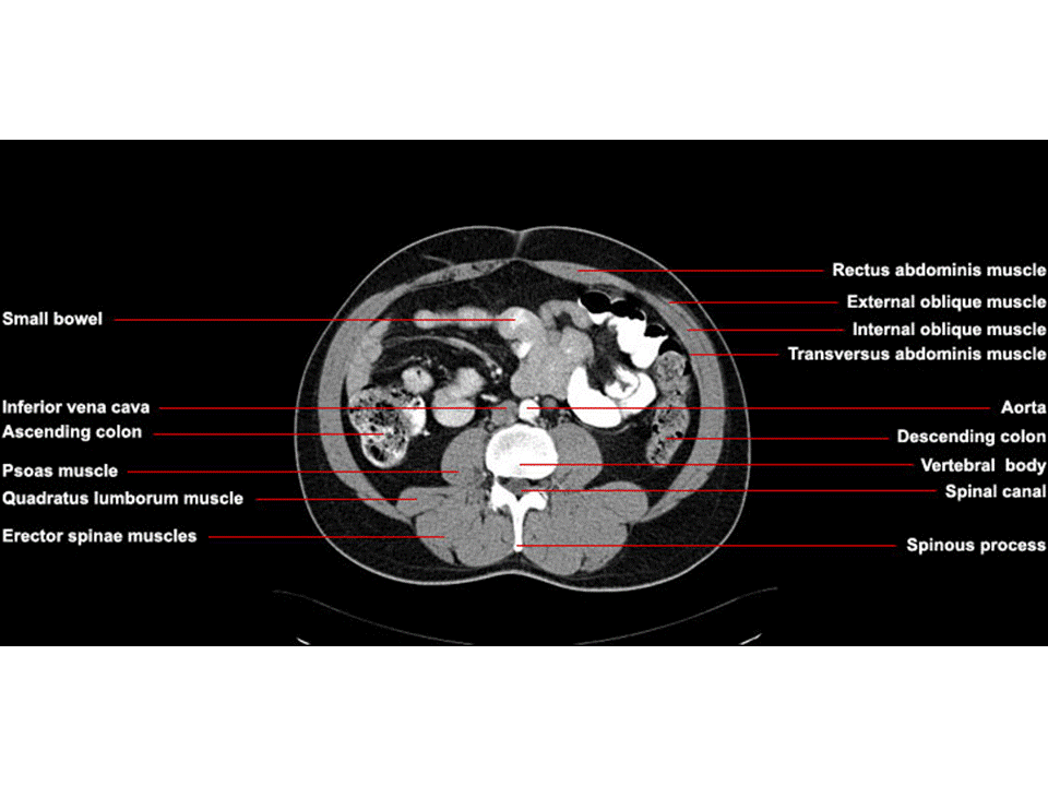 CT of the Abdomen Axial Anatomy – RADIOLOGYPICS.COM