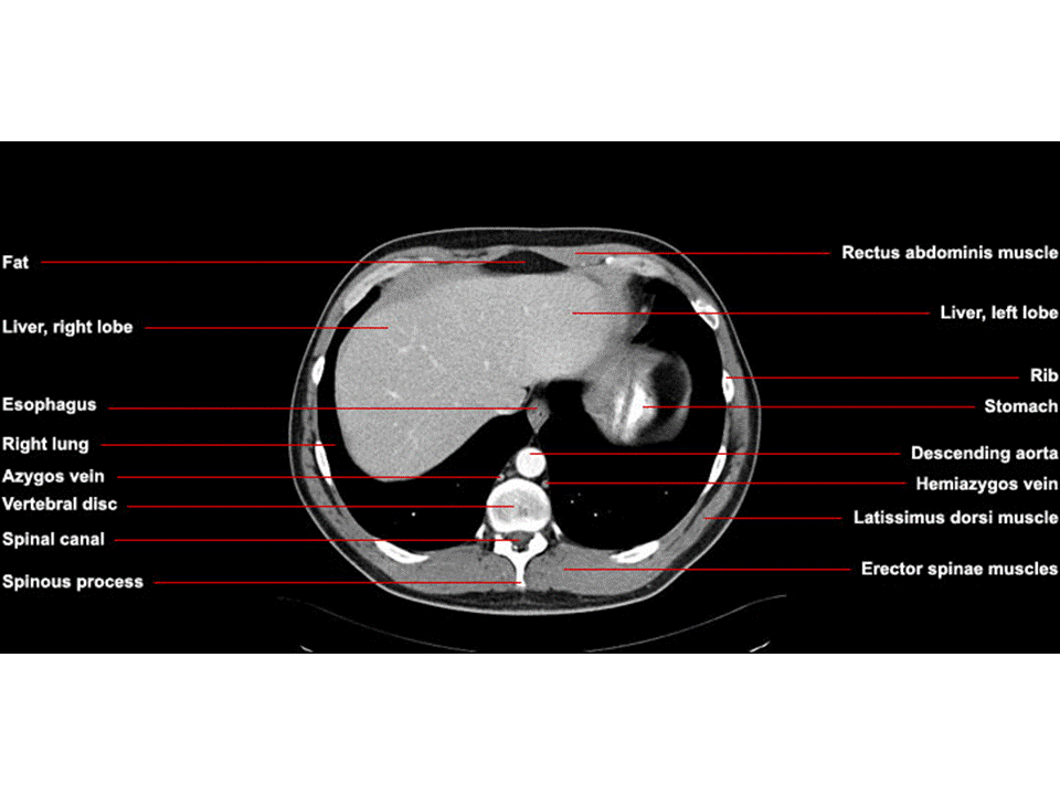 CT of the Chest Soft Tissue Windows Axial Anatomy – RADIOLOGYPICS.COM