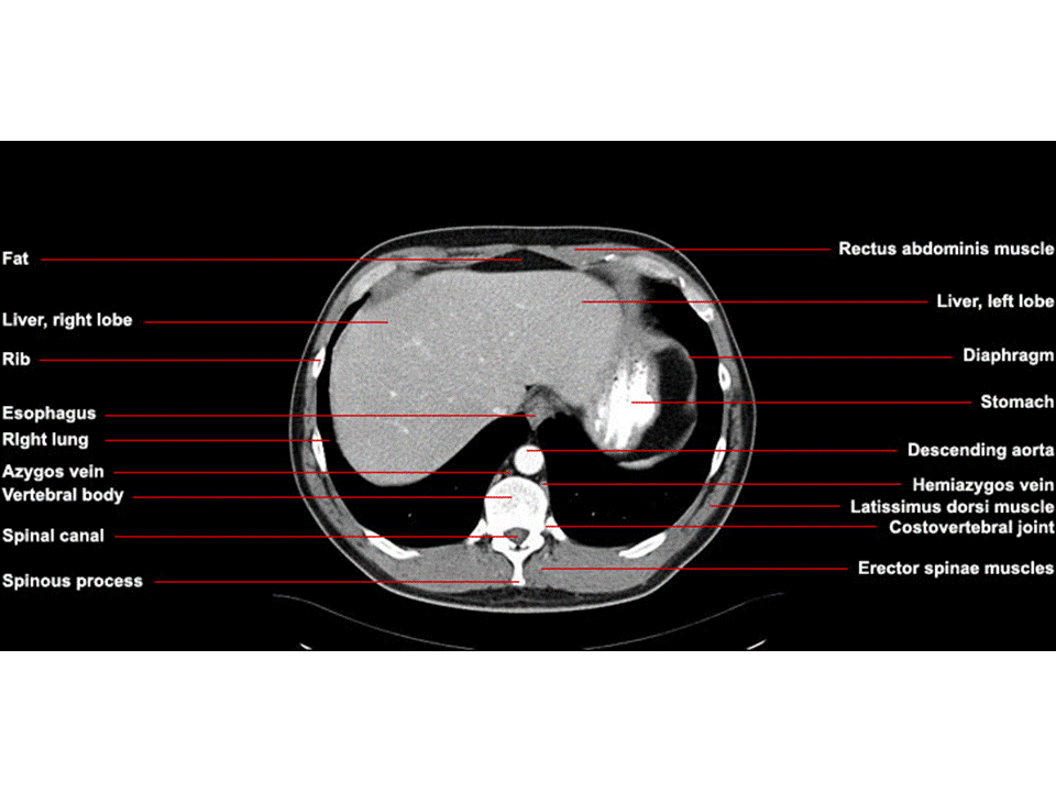 CT of the Chest Soft Tissue Windows Axial Anatomy – RADIOLOGYPICS.COM