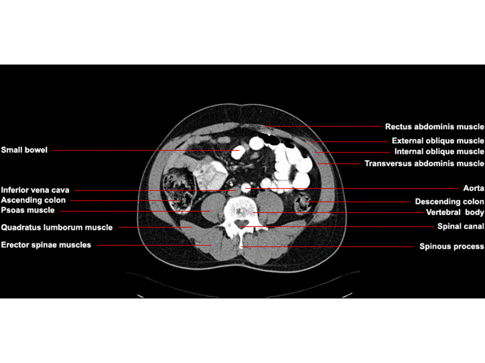 CT of the Abdomen Axial Anatomy – RADIOLOGYPICS.COM