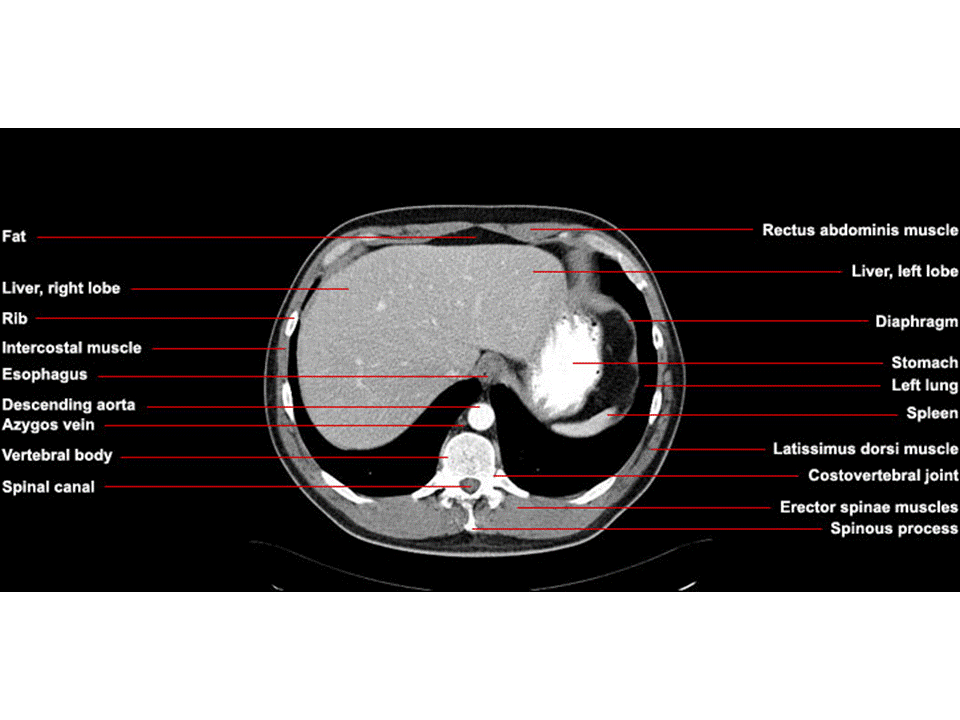 CT of the Chest Soft Tissue Windows Axial Anatomy – RADIOLOGYPICS.COM