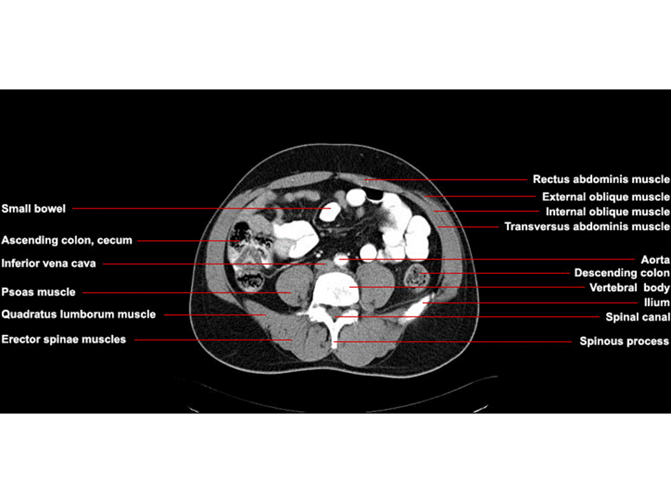 CT of the Abdomen Axial Anatomy – RADIOLOGYPICS.COM