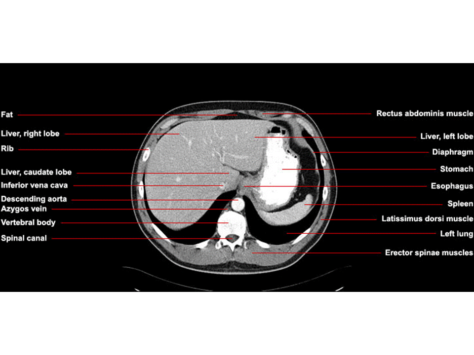 CT of the Chest Soft Tissue Windows Axial Anatomy – RADIOLOGYPICS.COM