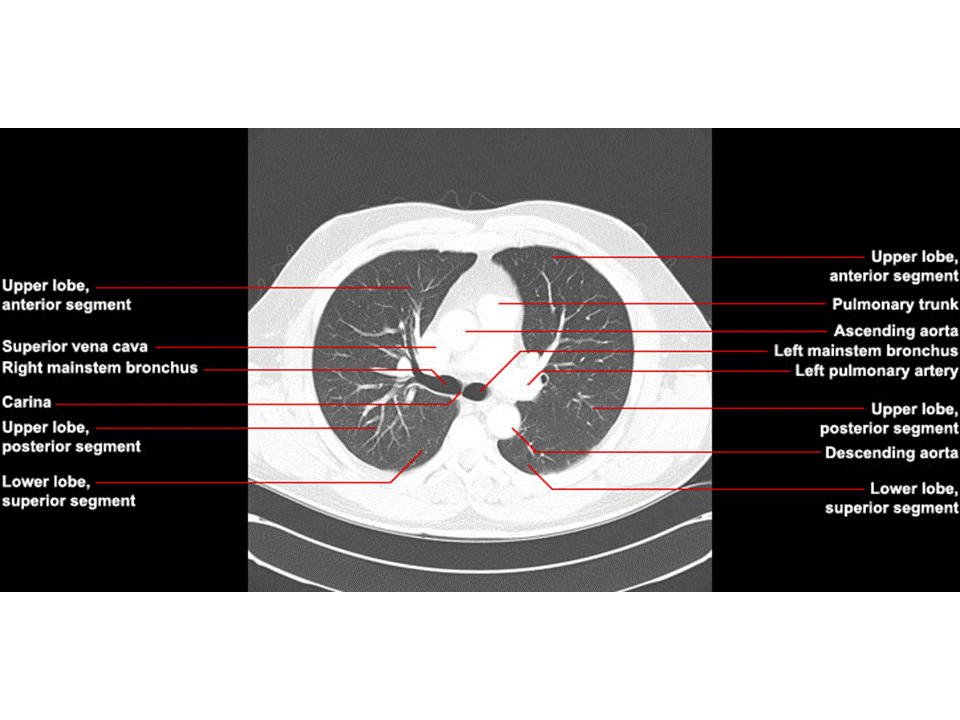 Lung Ct Anatomy Computed Tomography Of The Chest: I. Basic Principles