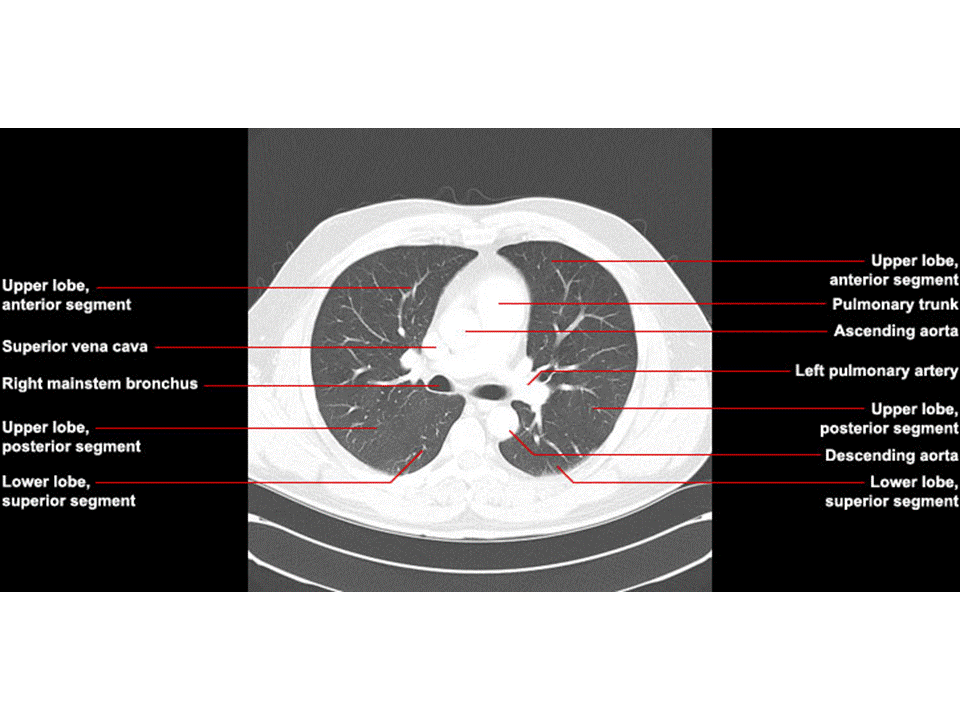 Bronchial Anatomy Ct