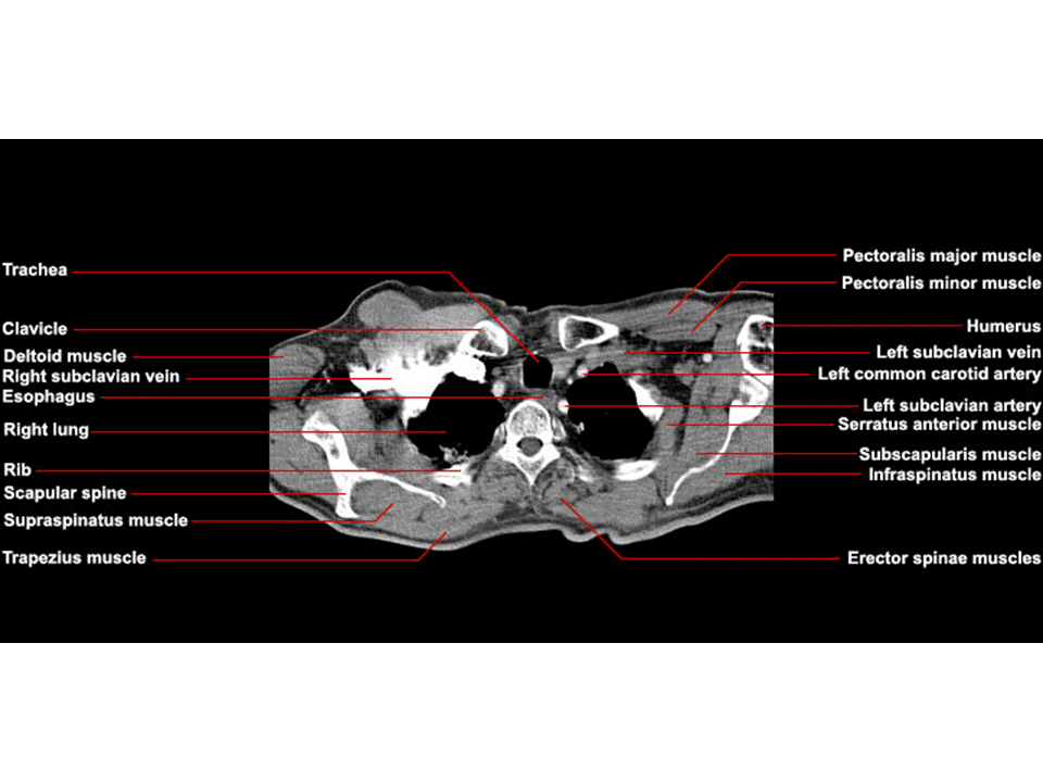CT of the Chest Soft Tissue Windows Axial Anatomy – RADIOLOGYPICS.COM