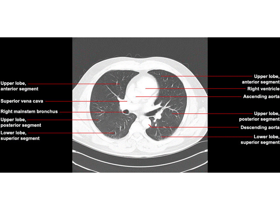 CT of the Chest Lung Windows Axial Anatomy – RADIOLOGYPICS.COM