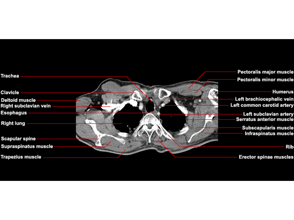 CT of the Chest Soft Tissue Windows Axial Anatomy – RADIOLOGYPICS.COM