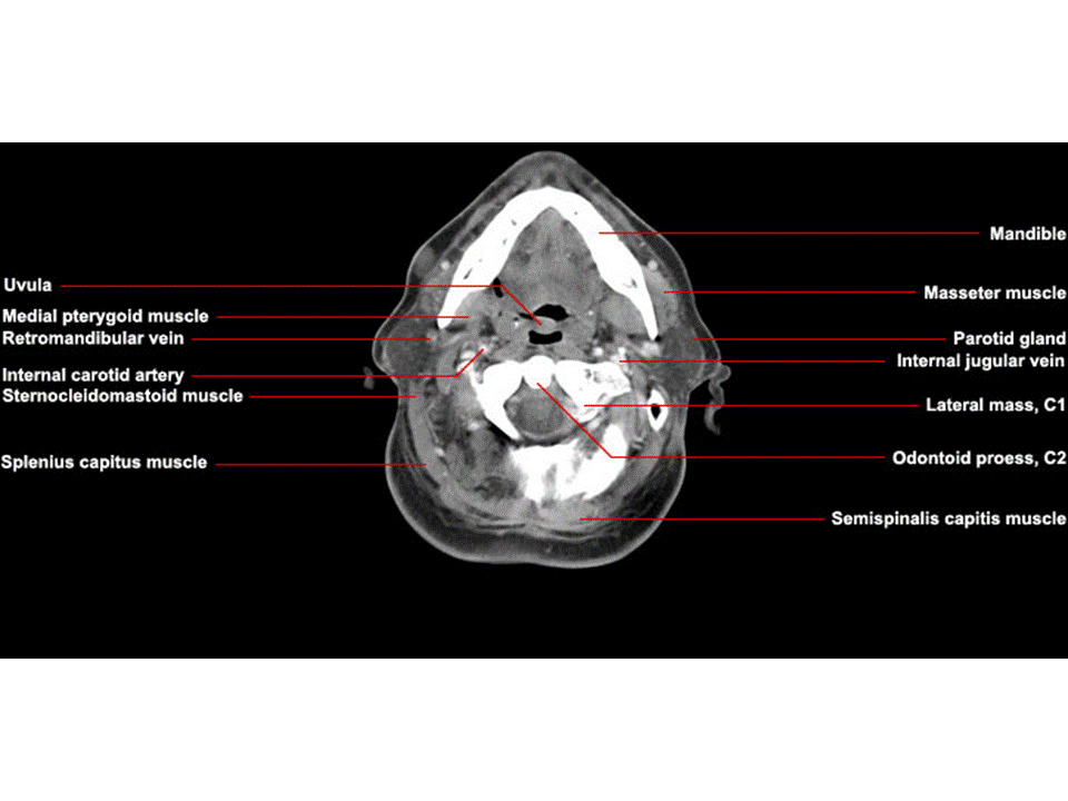 CT Neck Axial Anatomy – RADIOLOGYPICS.COM