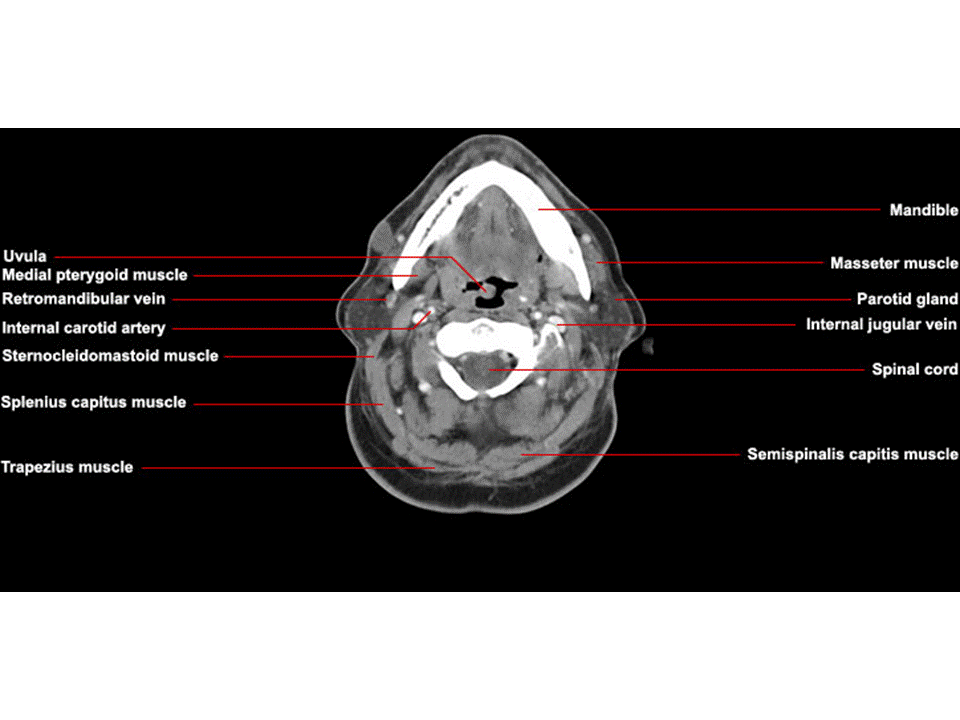 CT Neck Axial Anatomy – RADIOLOGYPICS.COM