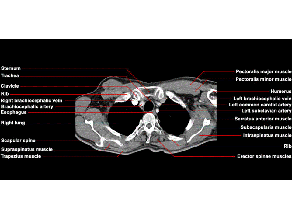 CT of the Chest Soft Tissue Windows Axial Anatomy – RADIOLOGYPICS.COM