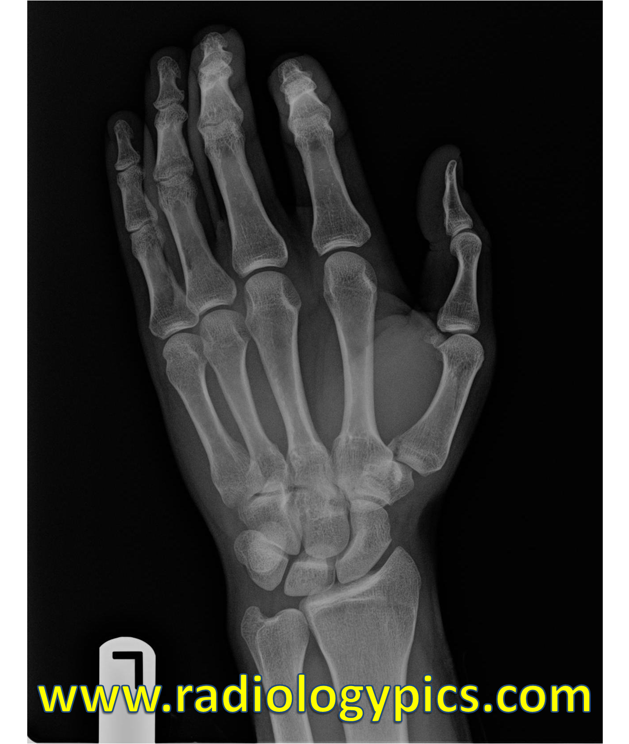 Unknown Case #25 – Hand Radiograph – RADIOLOGYPICS.COM