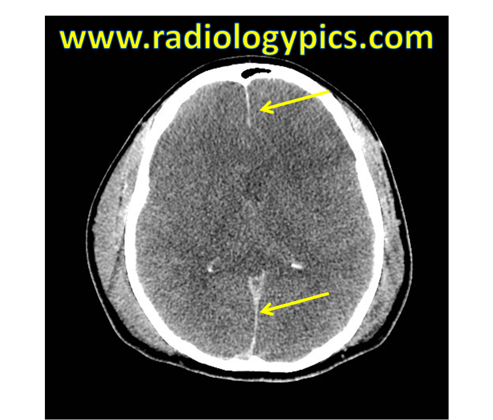 Diffuse Cerebral Edema – RADIOLOGYPICS.COM