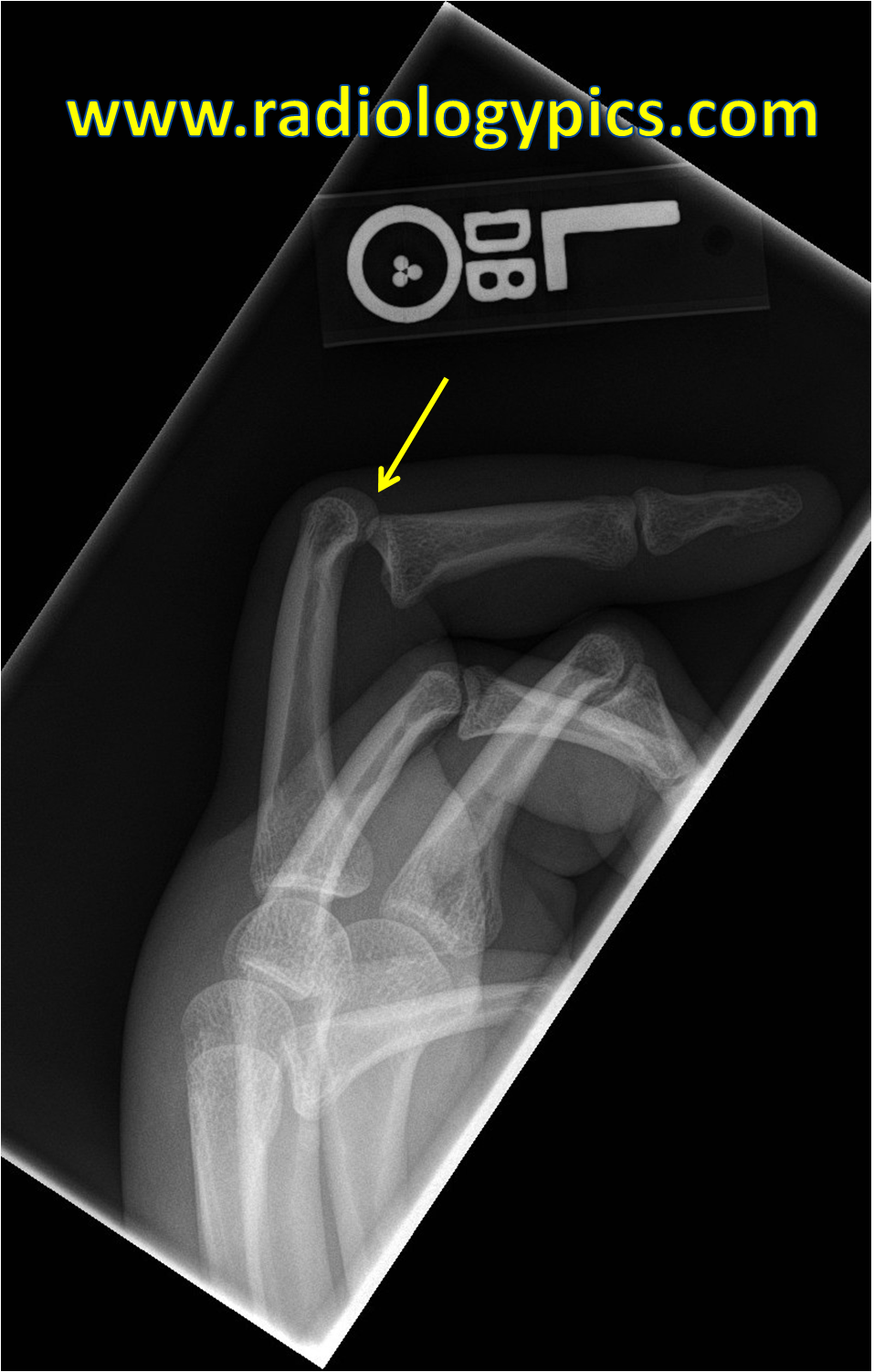 Volar Dislocated Proximal Interphalangeal Joint – RADIOLOGYPICS.COM