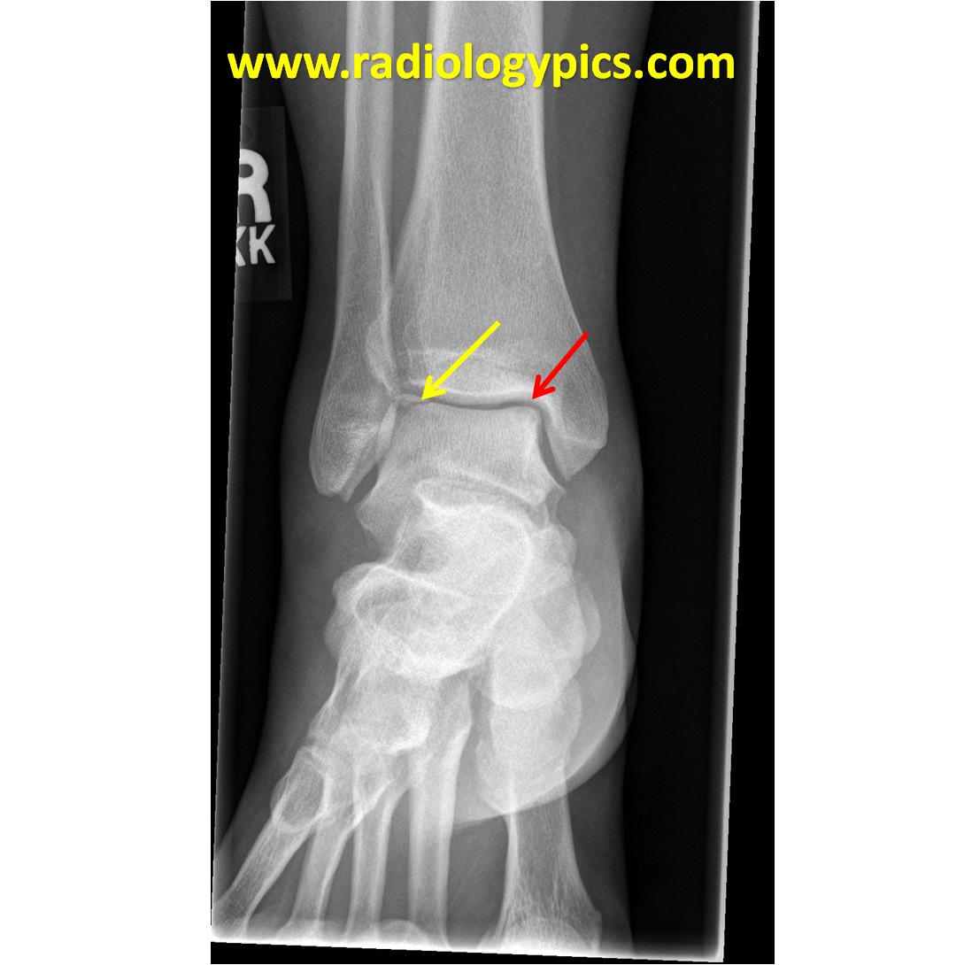 Osteochondral Injury Osteochondral Lesions Of The Talus Everything