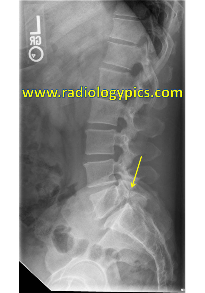 Pars Defects – Spondylolysis – RADIOLOGYPICS.COM