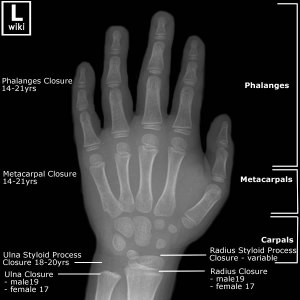 Pediatric Hand Anatomy - Pediatric Teleradiology