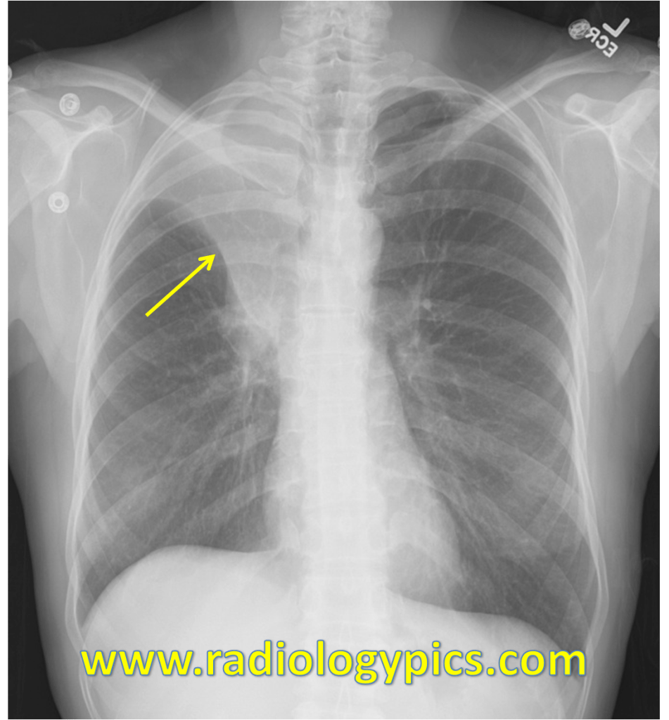 The Golden S Sign – Right Upper Lobe Collapse – RADIOLOGYPICS.COM