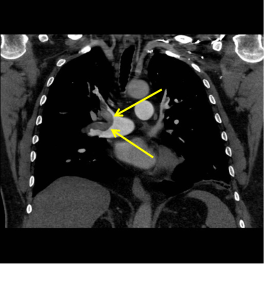 Acute Pulmonary Embolism – RADIOLOGYPICS.COM